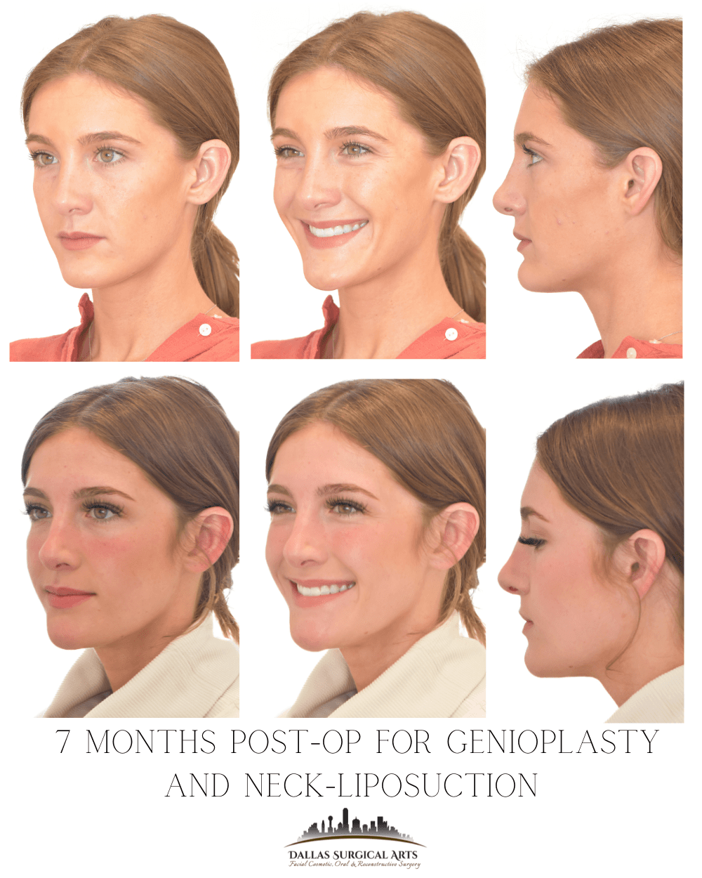 Genioplasty | Oral Surgery in Dallas