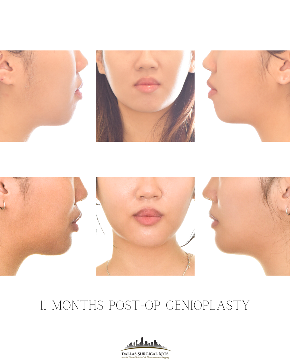 Genioplasty | Oral Surgery in Dallas