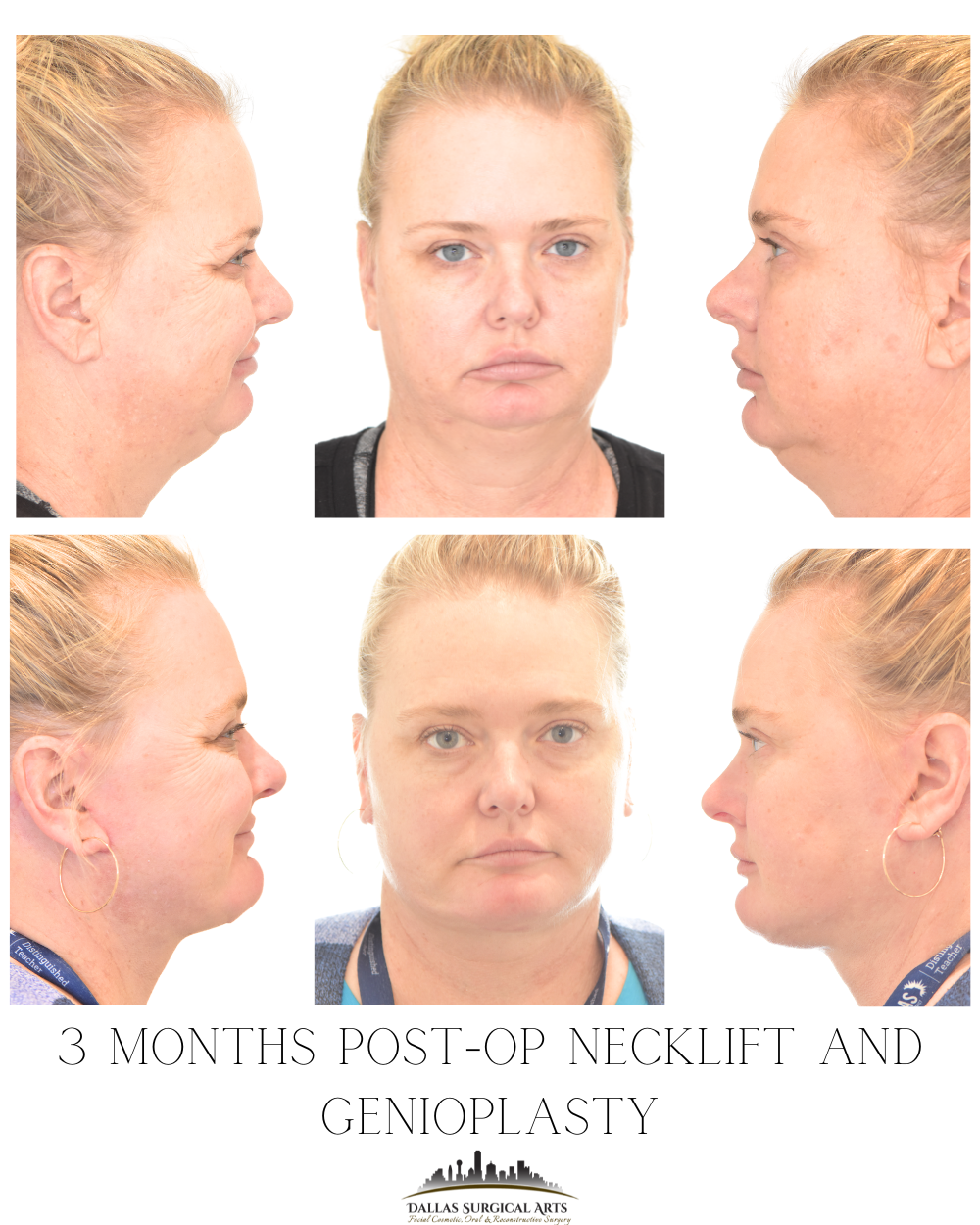 Genioplasty | Oral Surgery in Dallas