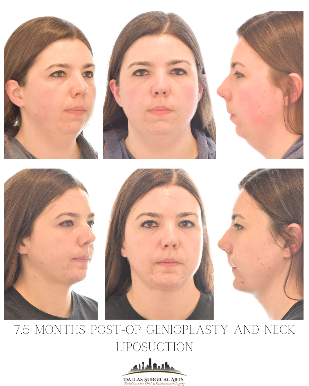 Genioplasty | Oral Surgery in Dallas