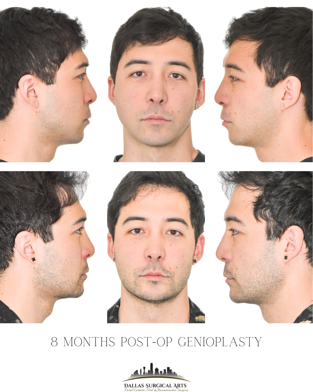 Best Chin Augmentation Surgeon in the US: Why You Should Consider Dr ...