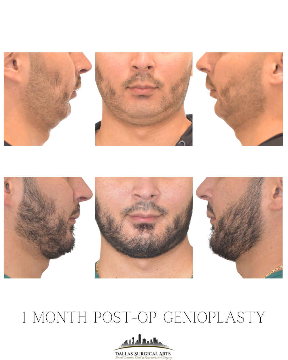 Genioplasty | Oral Surgery in Dallas