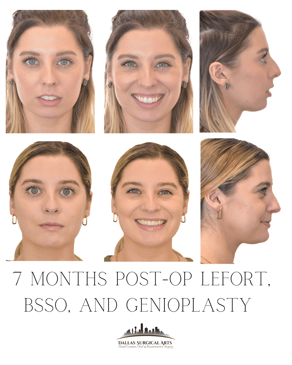 Genioplasty | Oral Surgery in Dallas
