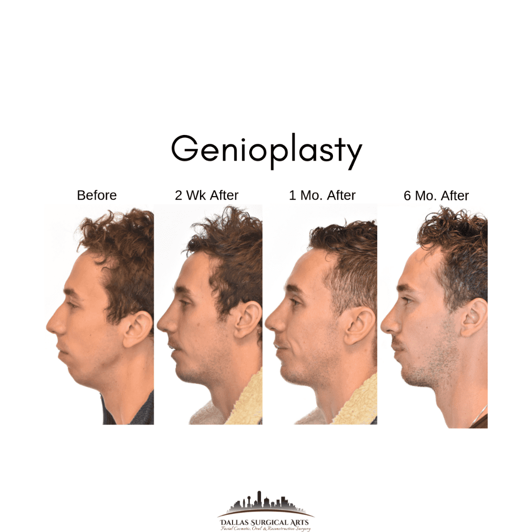 Genioplasty | Dallas Oral Surgery