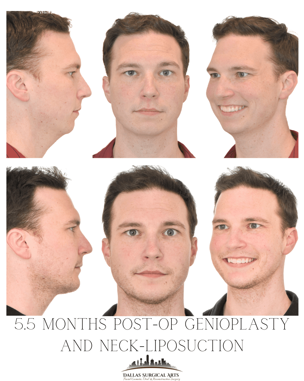 Genioplasty | Oral Surgery in Dallas