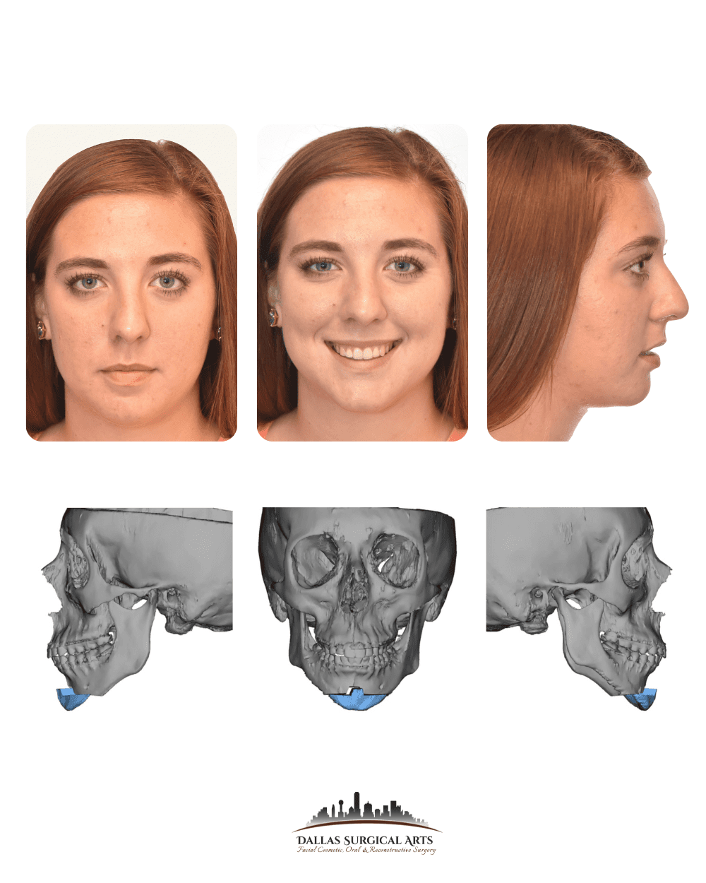 Genioplasty | Dallas Oral Surgery