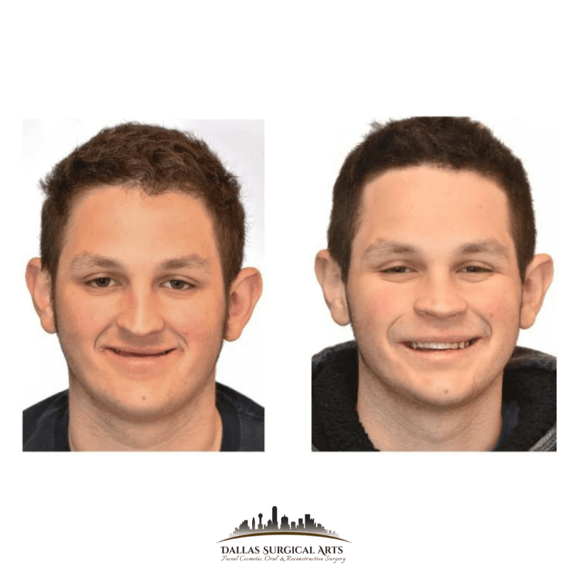 Condylar Growths Explained - Orthognathic and TMJ Surgery in Dallas by ...