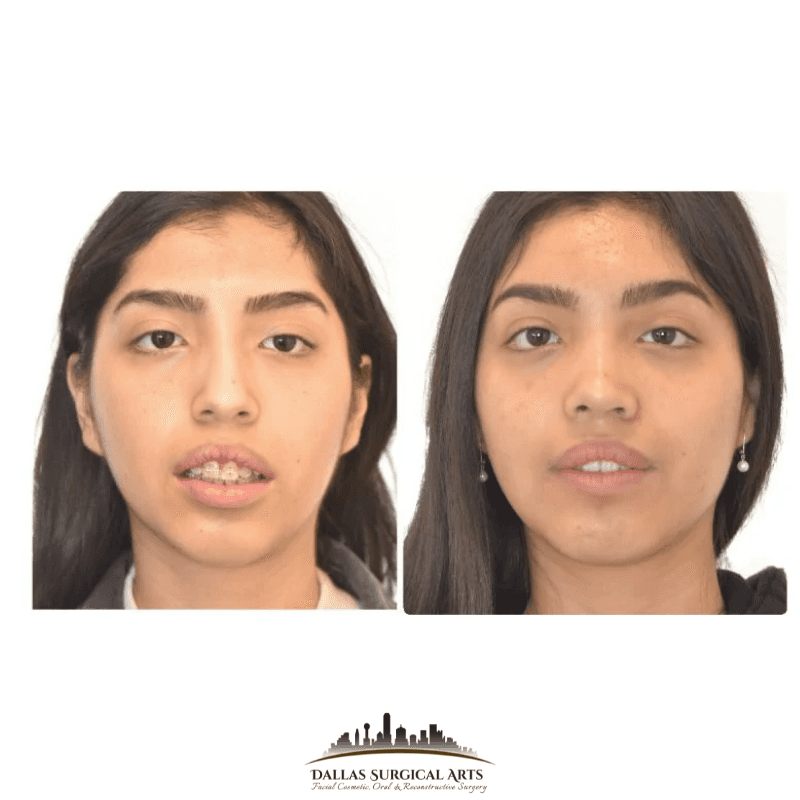 Jaw Repositioning (Orthognathic Surgery) | Dallas Surgical Arts