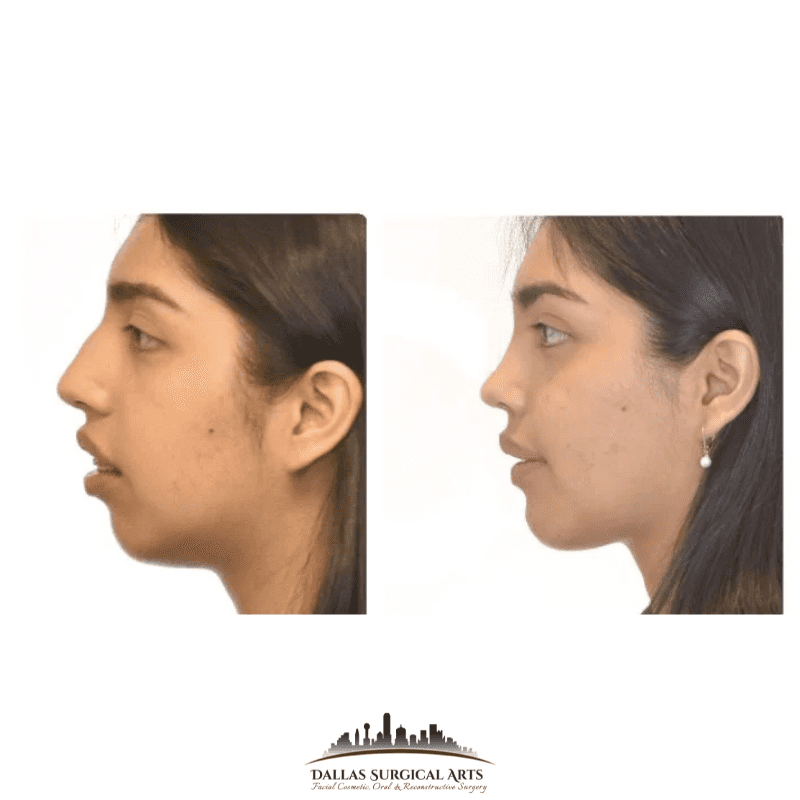 Jaw Repositioning (Orthognathic Surgery) | Dallas Surgical Arts