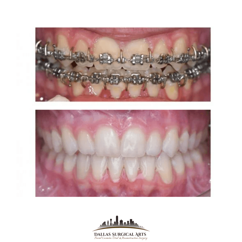 Jaw Repositioning (Orthognathic Surgery) | Dallas Surgical Arts