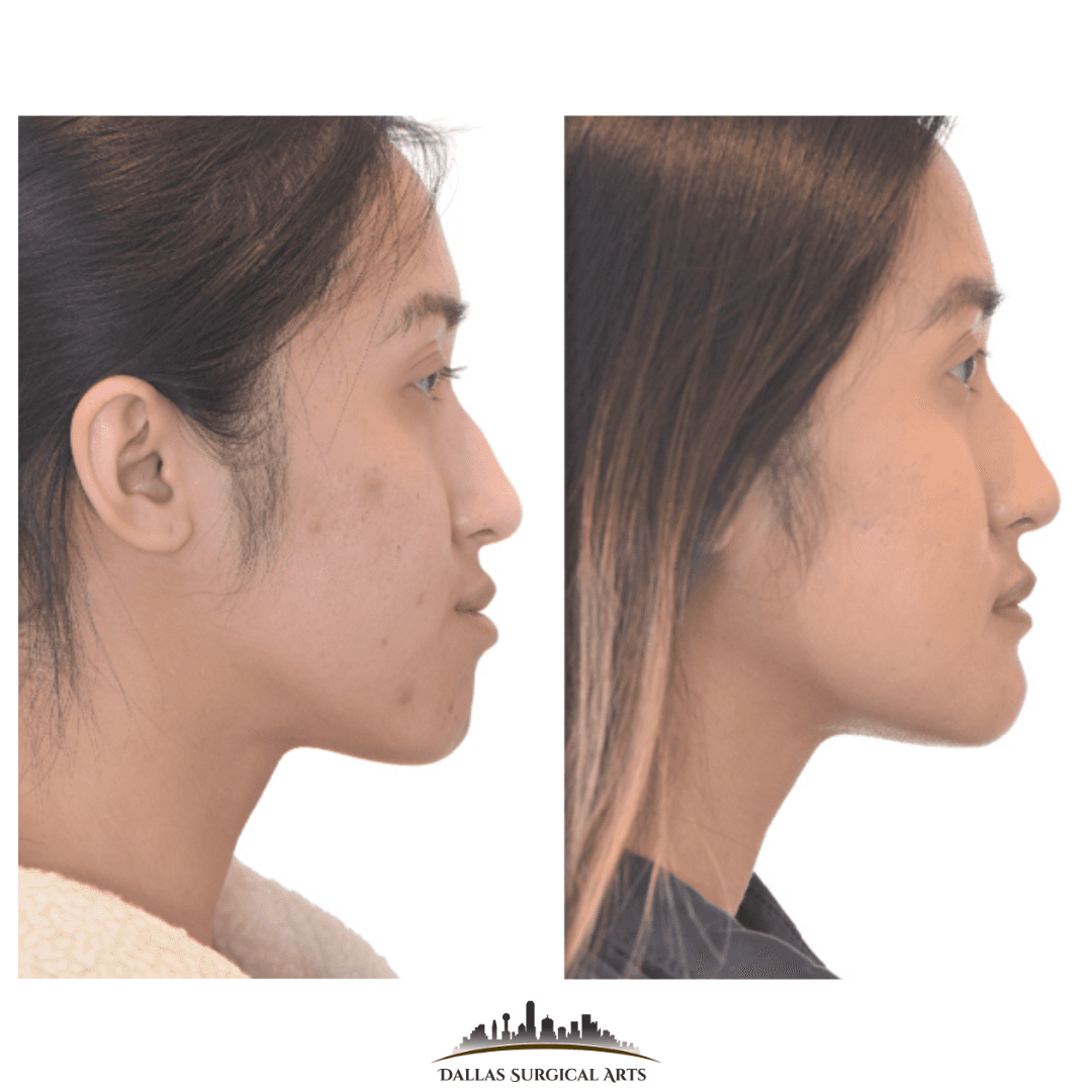 Jaw Repositioning (Orthognathic Surgery) | Dallas Surgical Arts