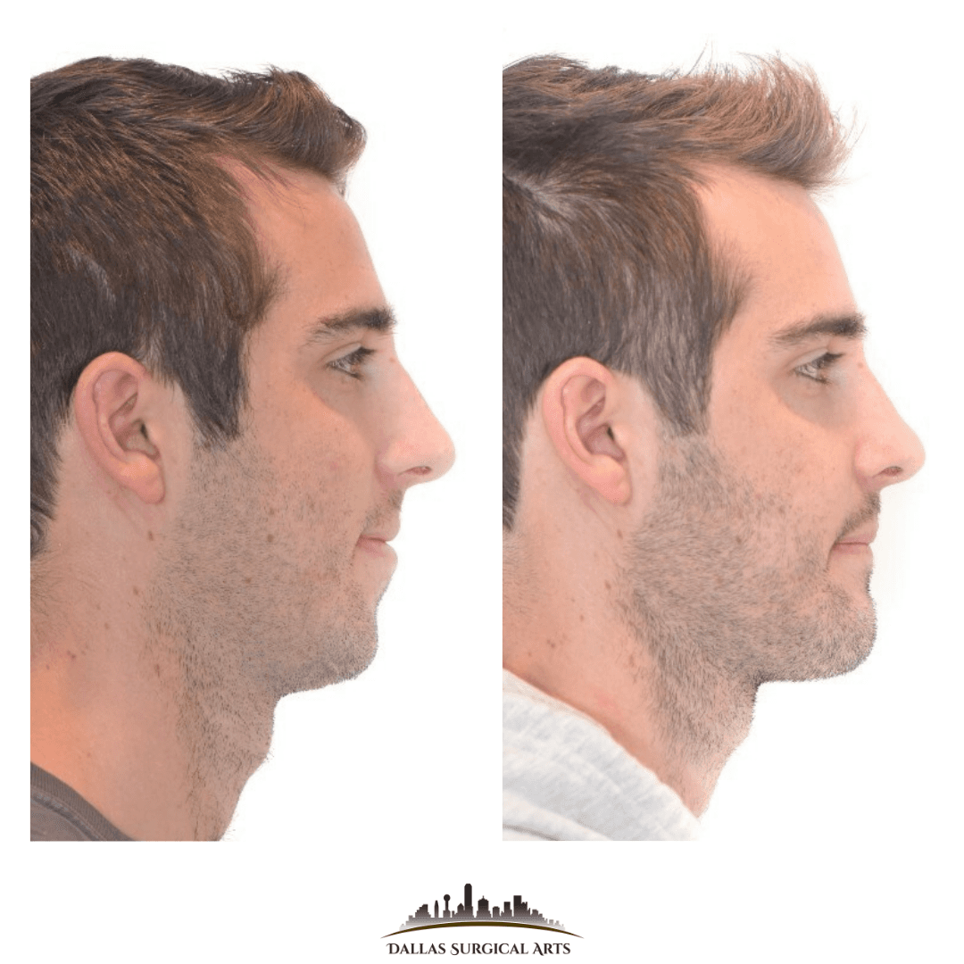 Jaw Repositioning (Orthognathic Surgery) | Dallas Surgical Arts