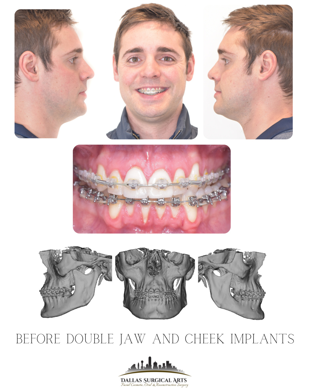 Jaw Repositioning (Orthognathic Surgery) | Dallas Surgical Arts