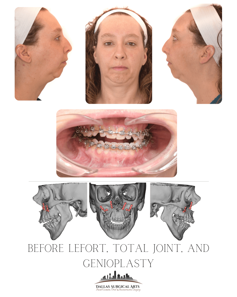 Jaw Repositioning (Orthognathic Surgery) | Dallas Surgical Arts