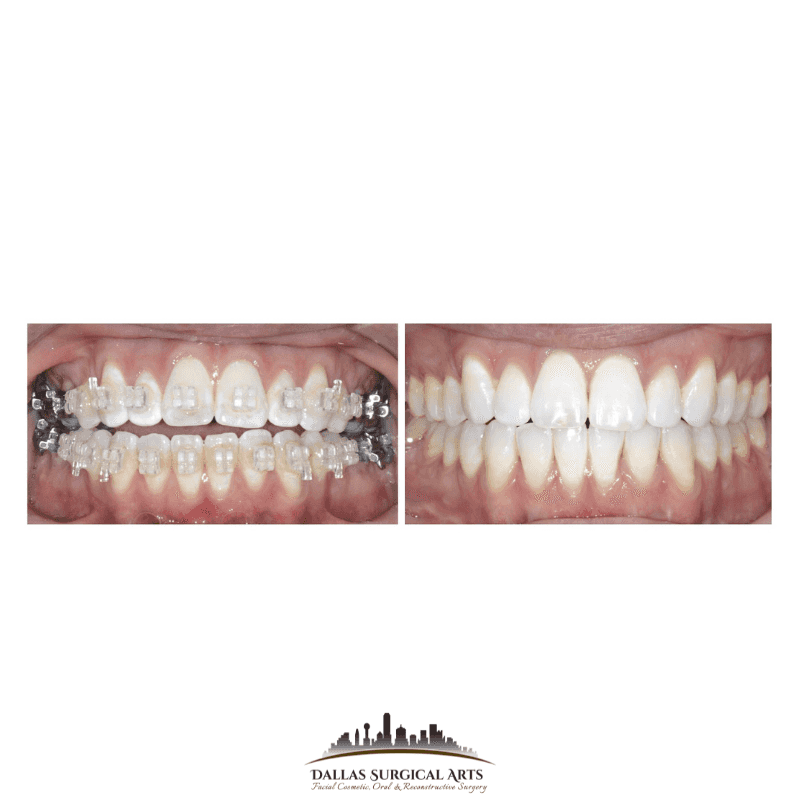 Jaw Repositioning (Orthognathic Surgery) | Dallas Surgical Arts