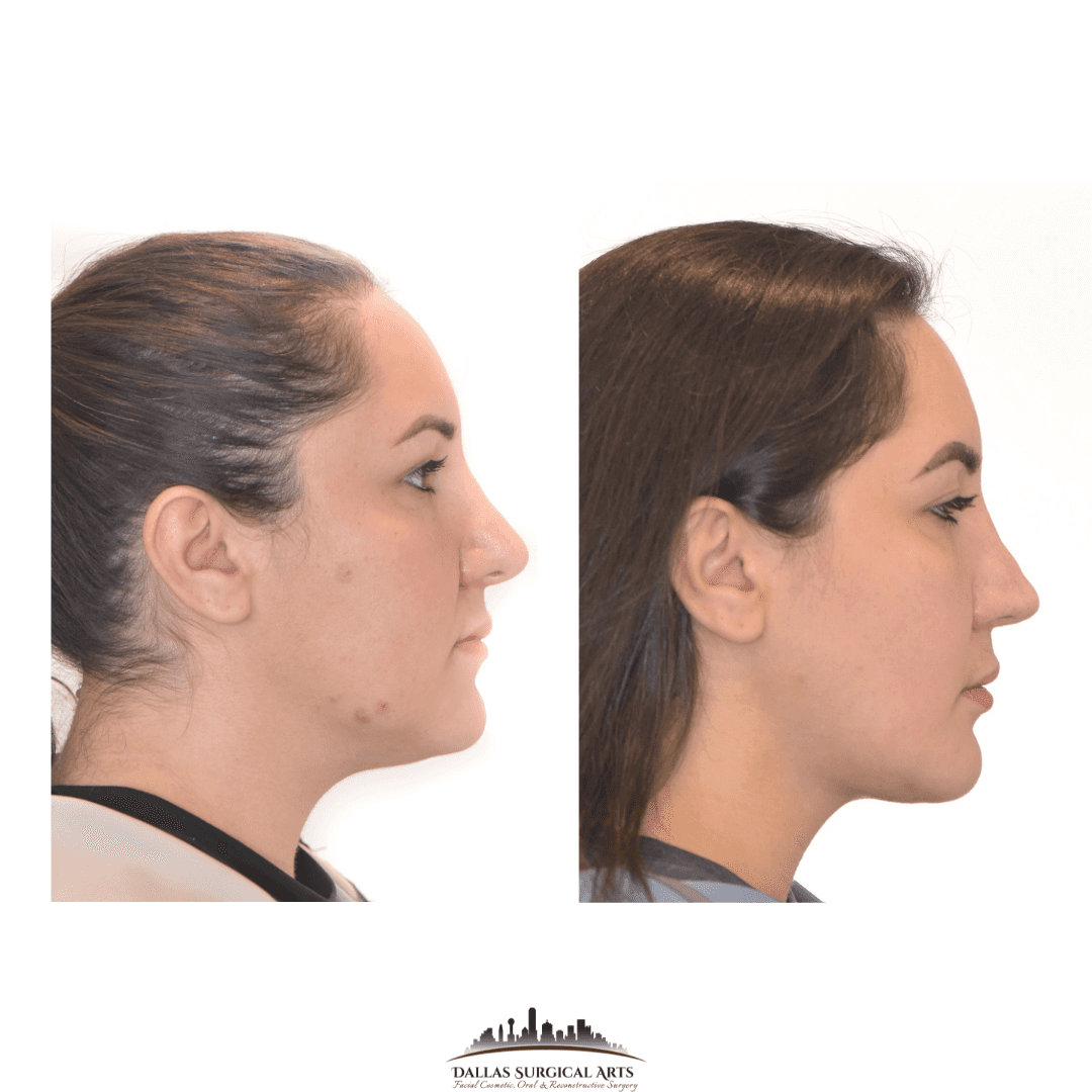 Jaw Repositioning (Orthognathic Surgery) | Dallas Surgical Arts