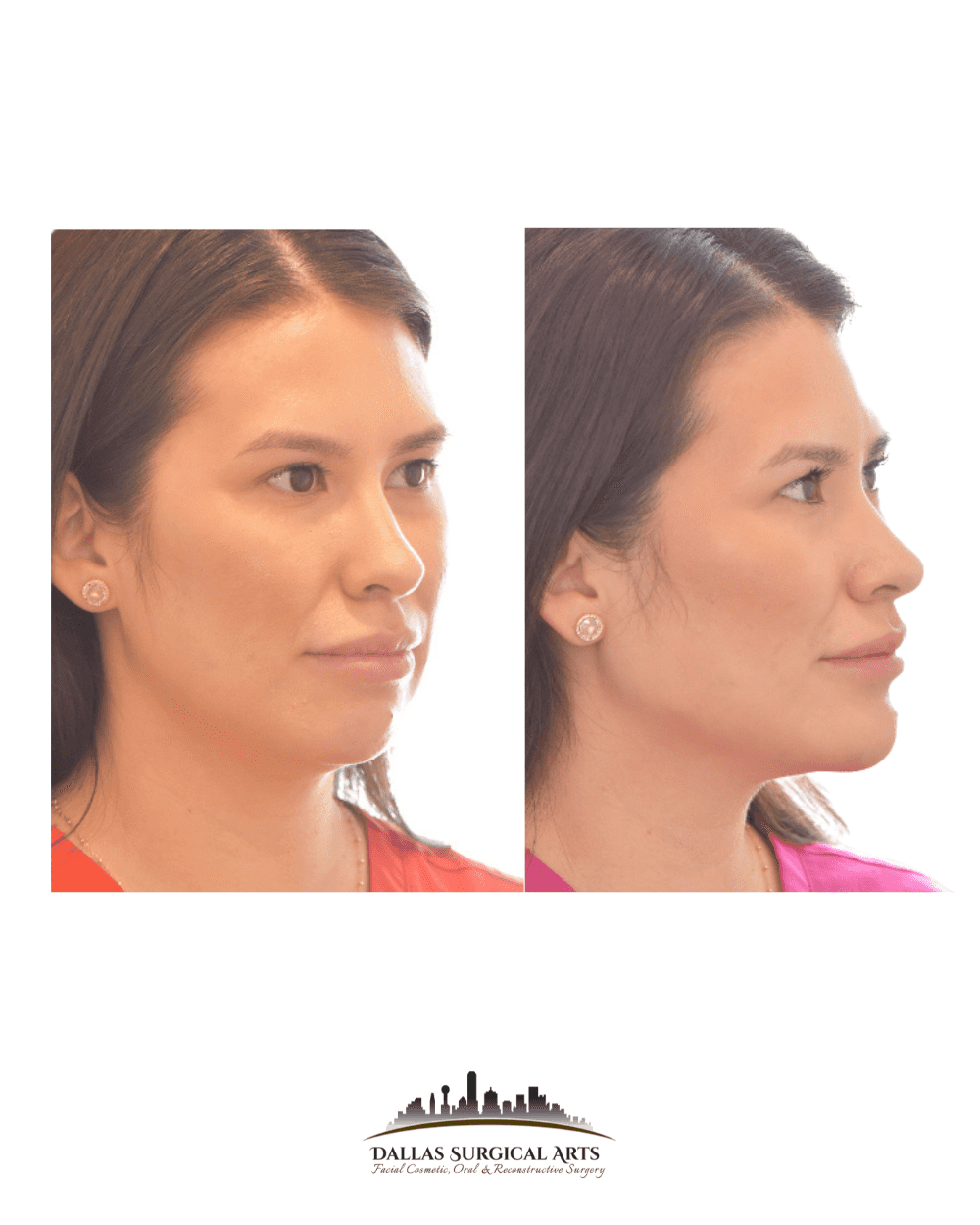 Jawline Filler | Oral Surgery in Dallas