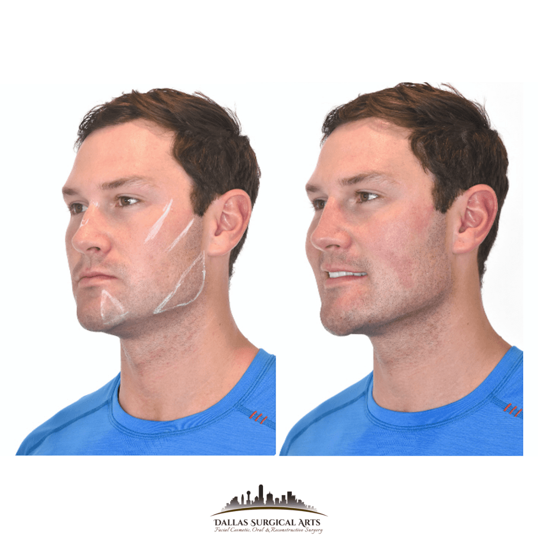 Jawline Filler | Oral Surgery in Dallas