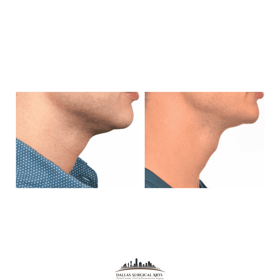Kybella | Dallas Surgical Arts