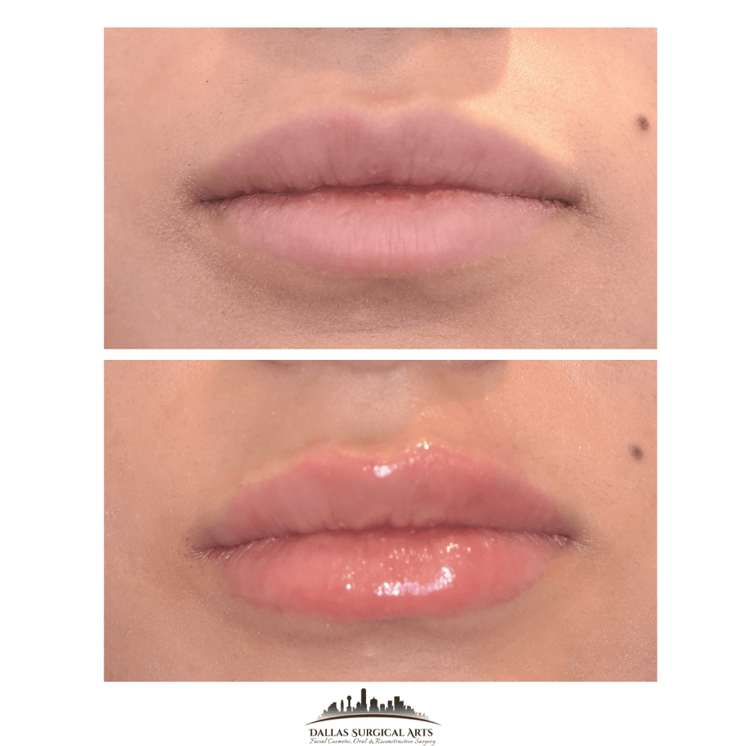 Lip Filler | Dallas Surgical Arts