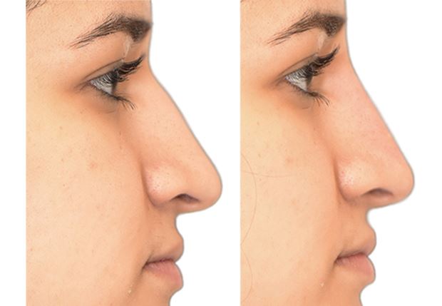 Liquid Rhino | Dallas Oral Surgery