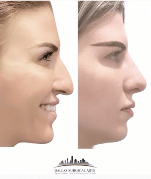 Liquid Rhino | Dallas Oral Surgery