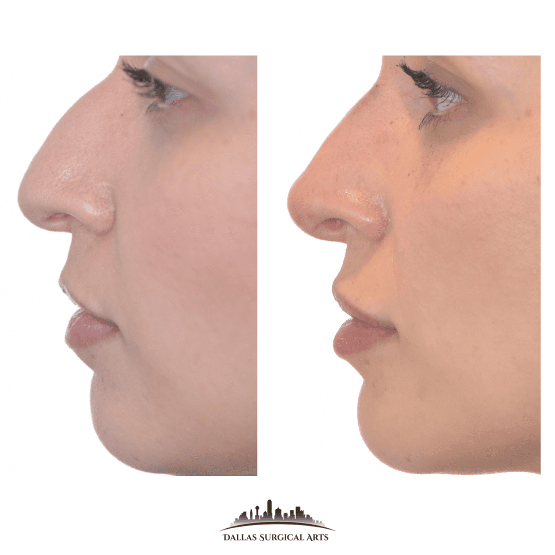 Liquid Rhino | Dallas Oral Surgery