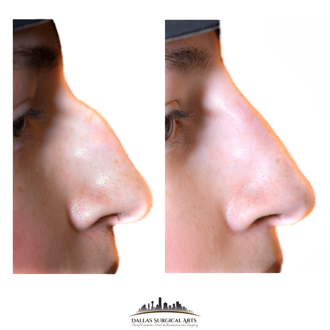 Liquid Rhino | Dallas Oral Surgery