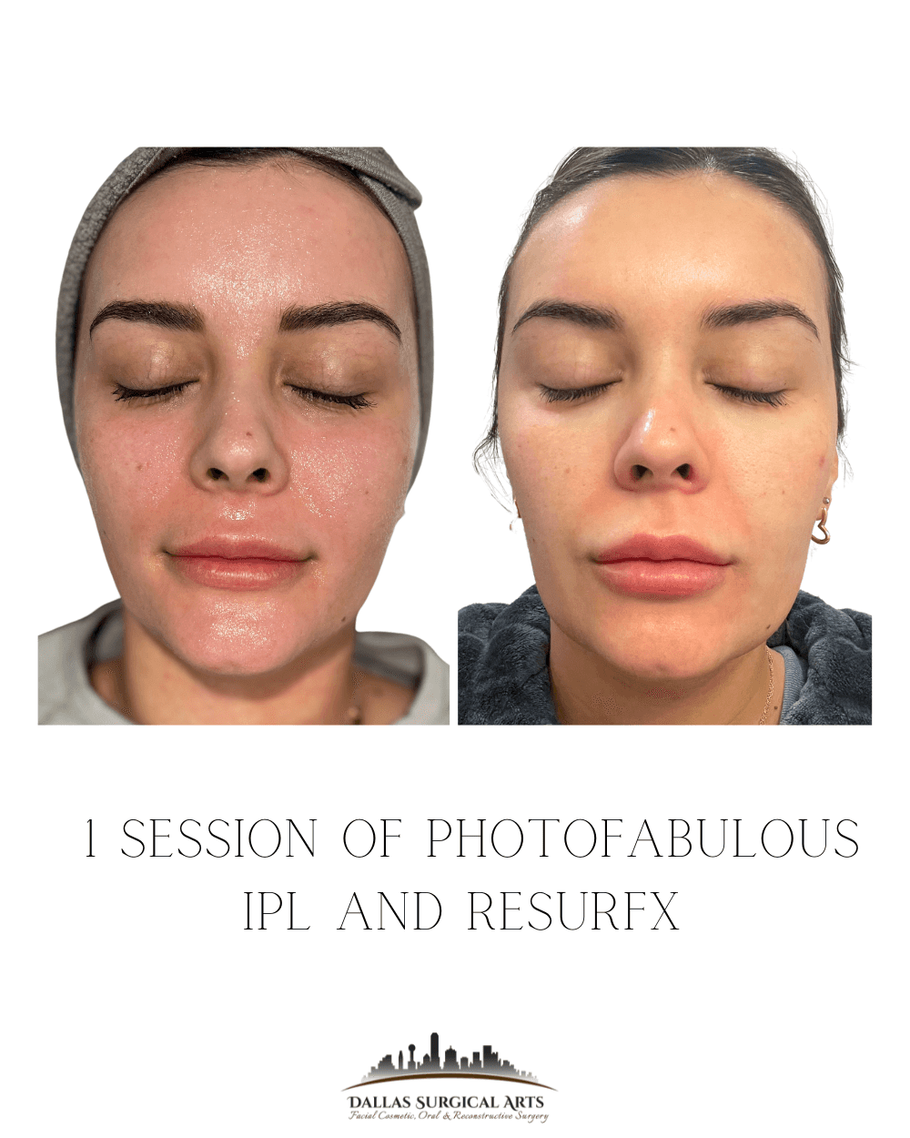 M22 IPL + RESURFX
