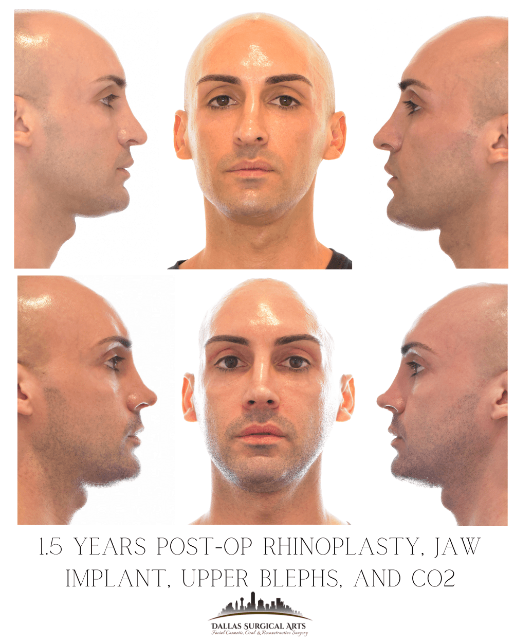 Mandibular Implants | Dallas Oral Surgery