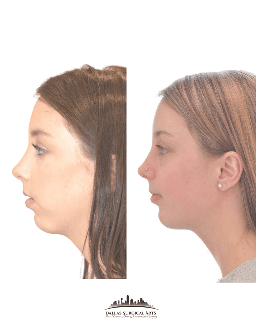 Mandibular Implants | Dallas Oral Surgery