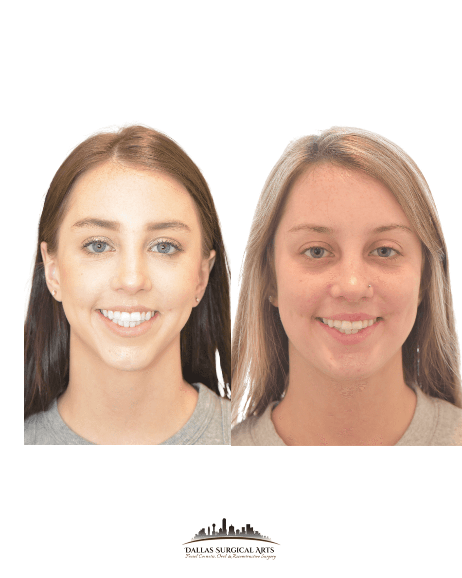 Mandibular Implants | Dallas Oral Surgery