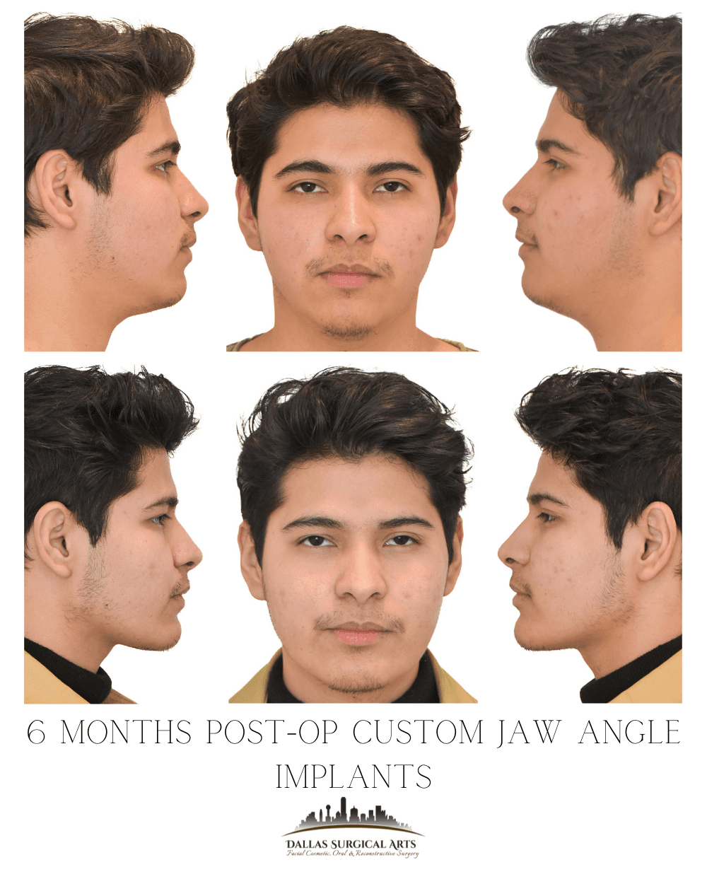 Mandibular Implants | Dallas Oral Surgery