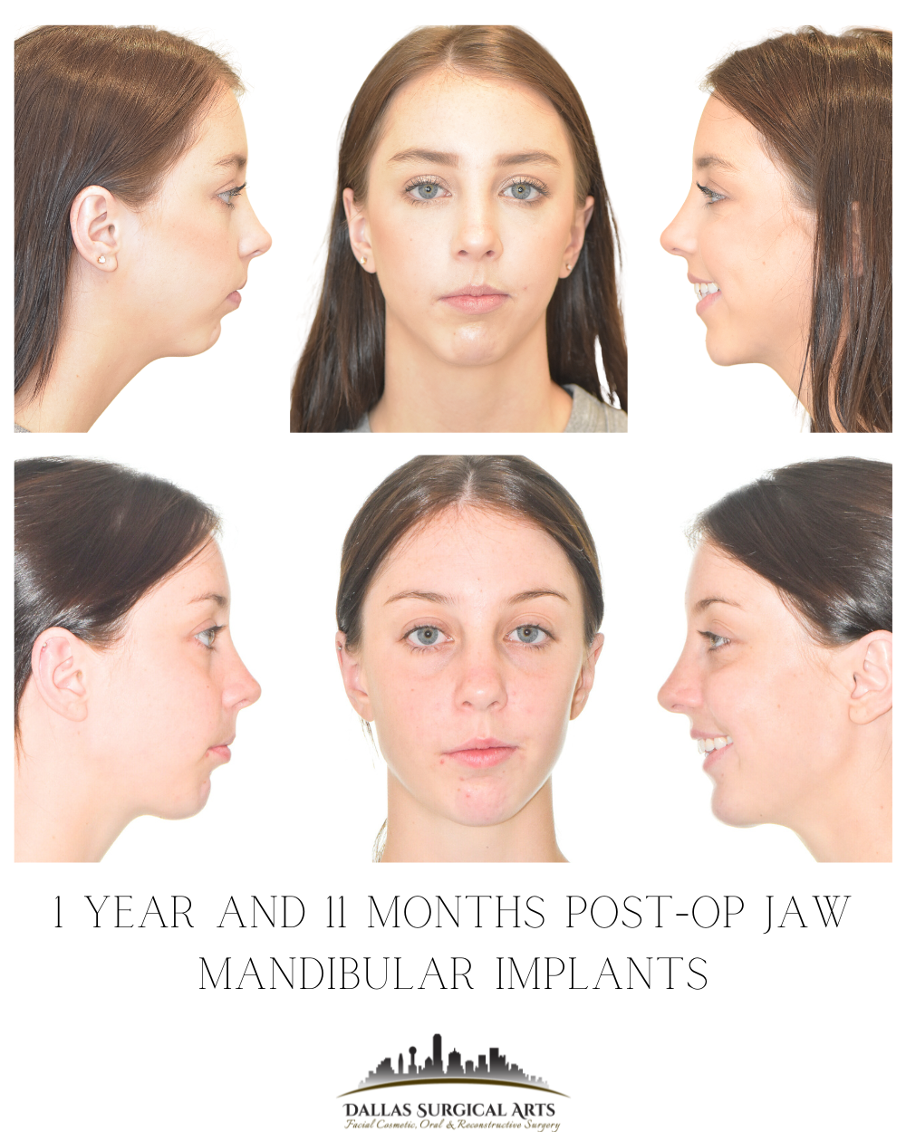 Mandibular Implants | Dallas Oral Surgery