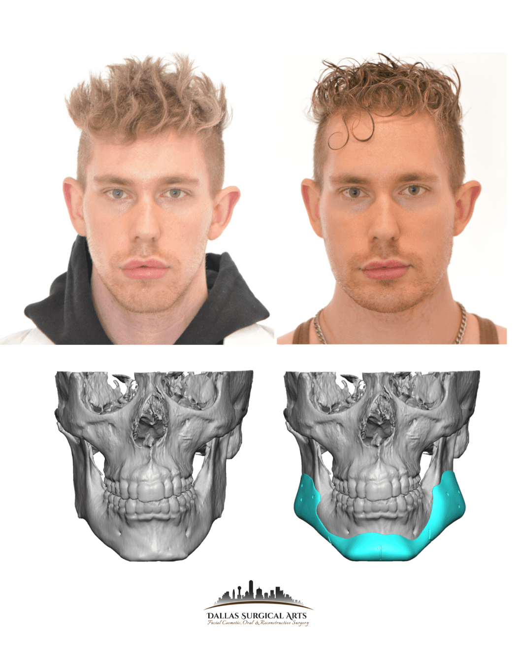 Mandibular Implants