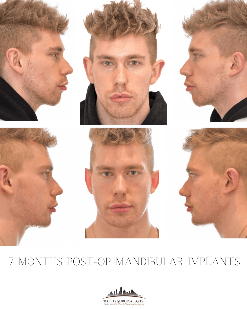 Mandibular Implants | Dallas Oral Surgery