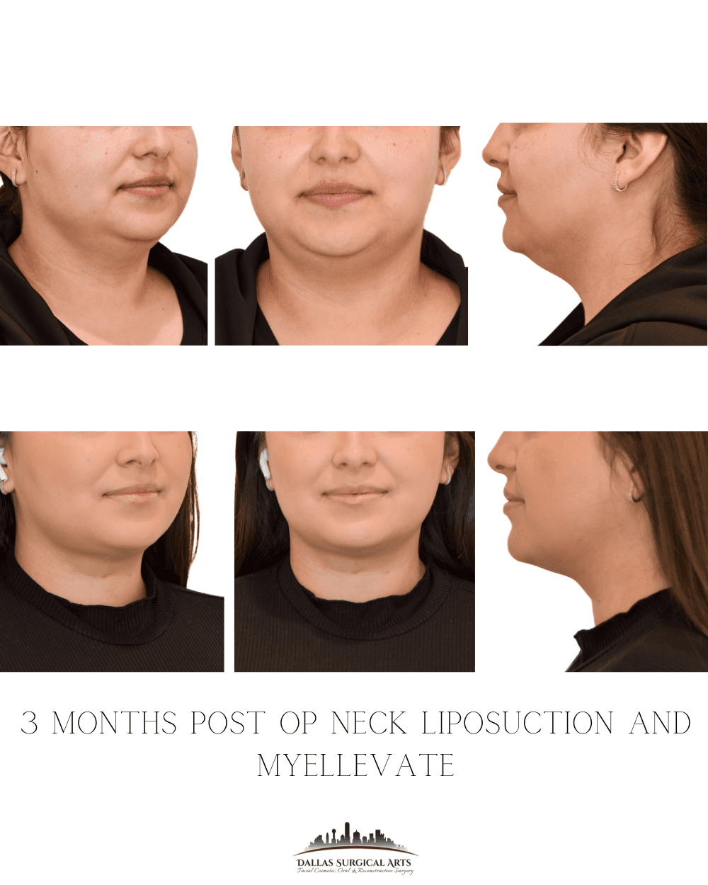 MyEllevate | Dallas Surgical Arts