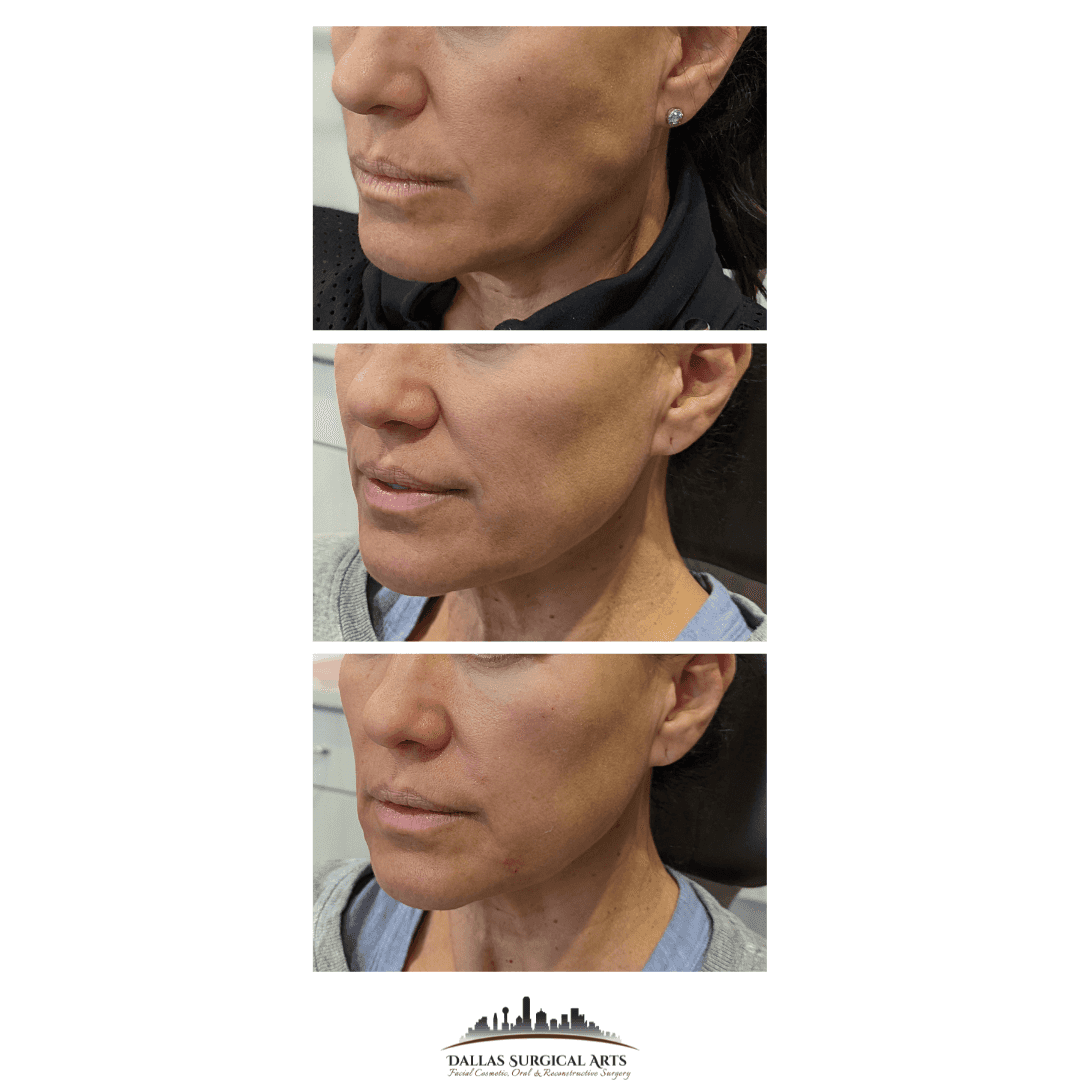 Nasal Labial Folds | Oral Surgery in Dallas