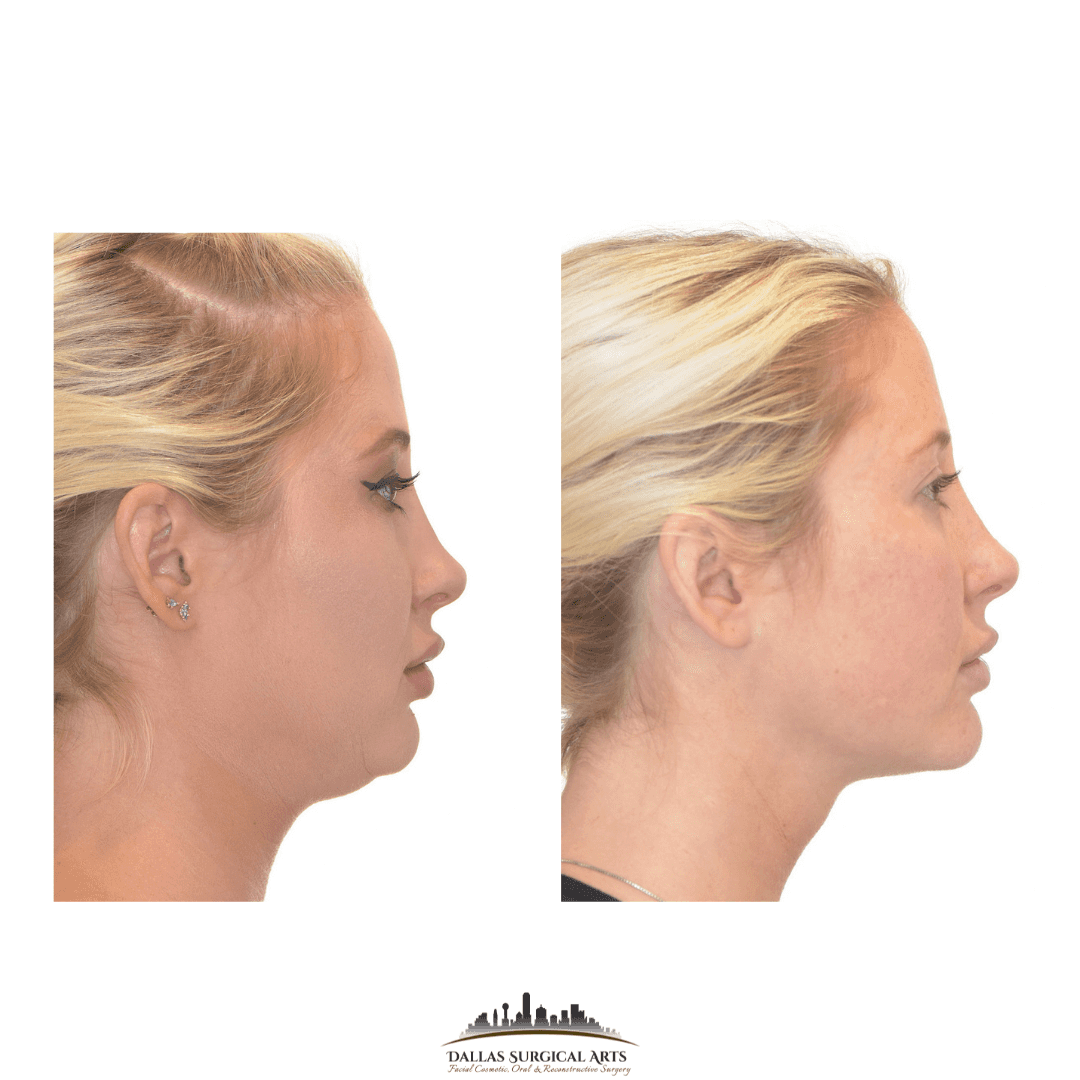 Neck Lipo