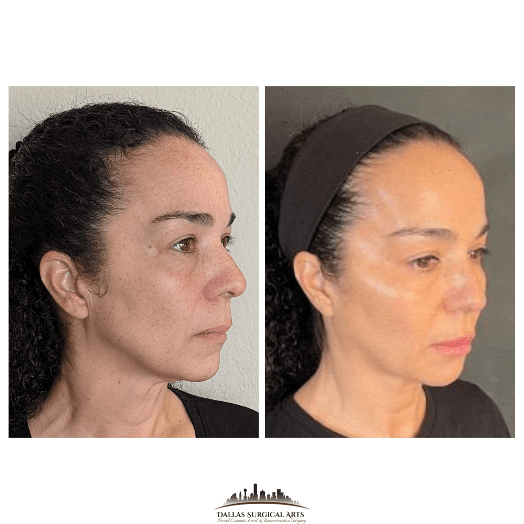 NovaThreads | Oral Surgery in Dallas