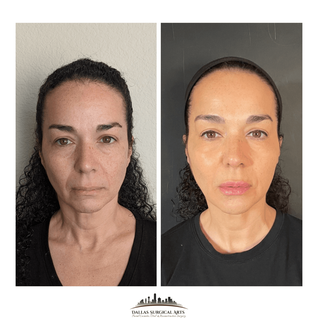 NovaThreads | Oral Surgery in Dallas