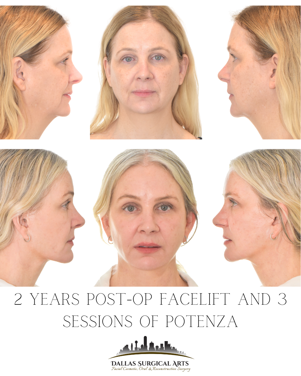 How to Stop a Wrinkly Neck with a Neck Lift and Other Facial Tightening ...