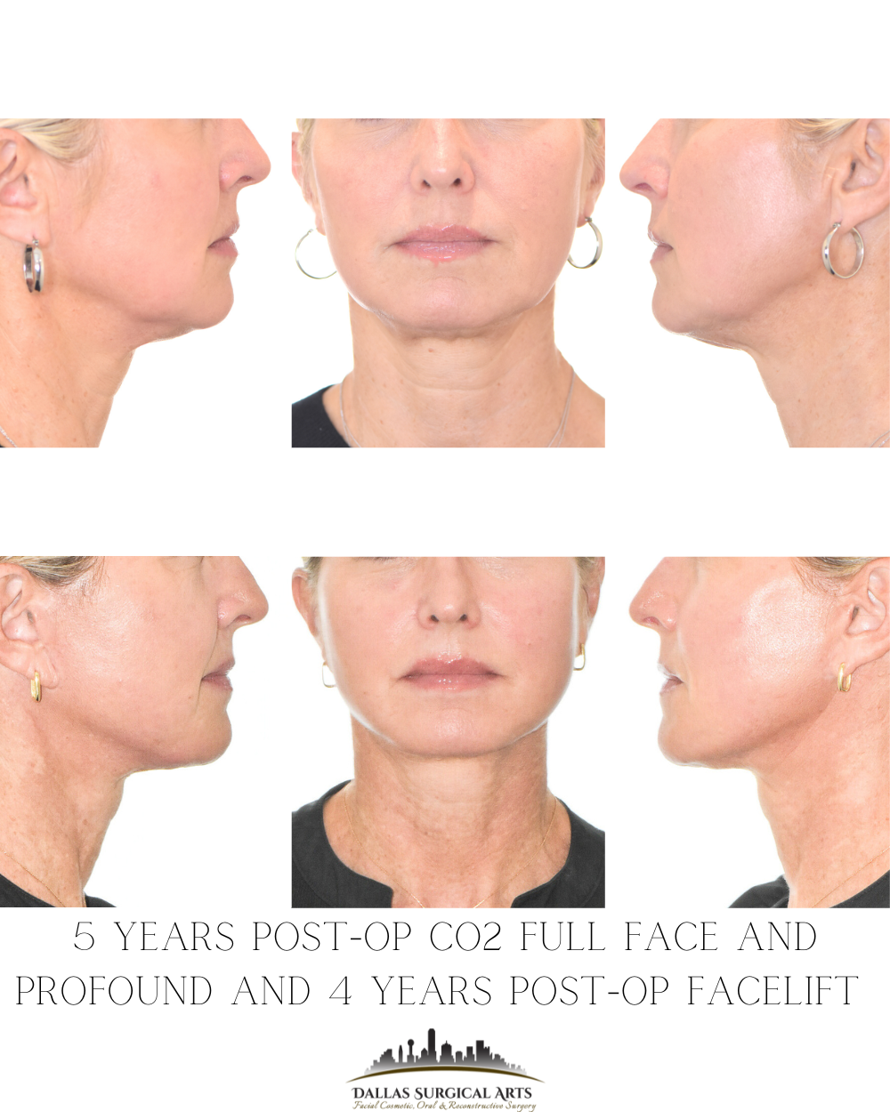 Profound RF | Dallas Oral Surgery