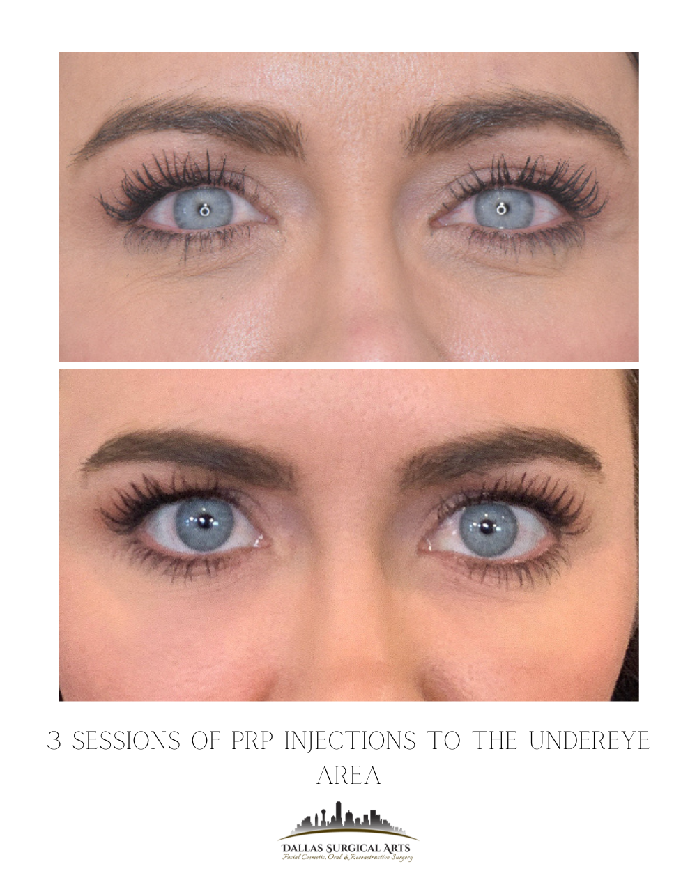 PRP Injections | Dallas Surgical Arts