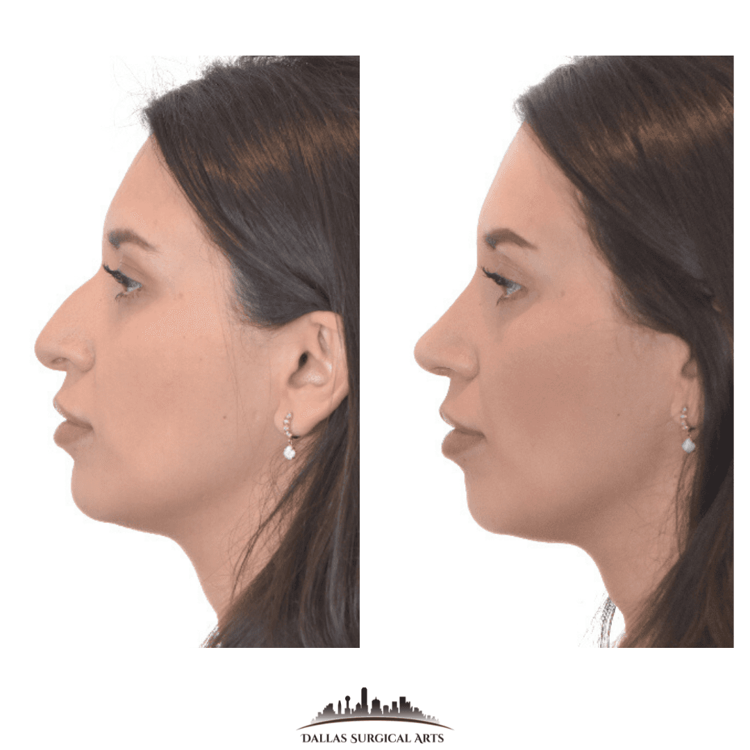 Enhancing Your Features: Different Nose Shapes for Rhinoplasty