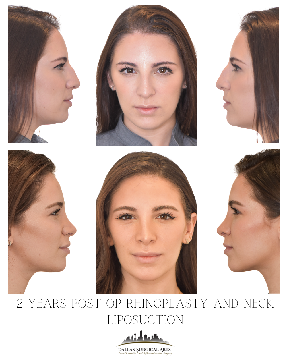 A Simple Guide to the Different Types of Nose Shapes