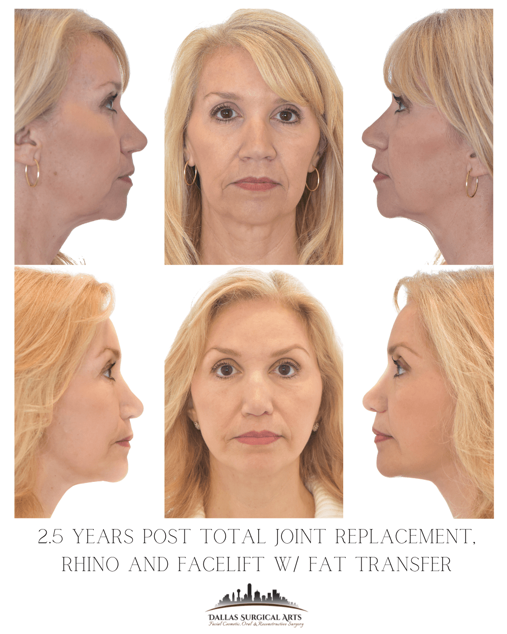 TMJ Surgery | Dallas Oral Surgery