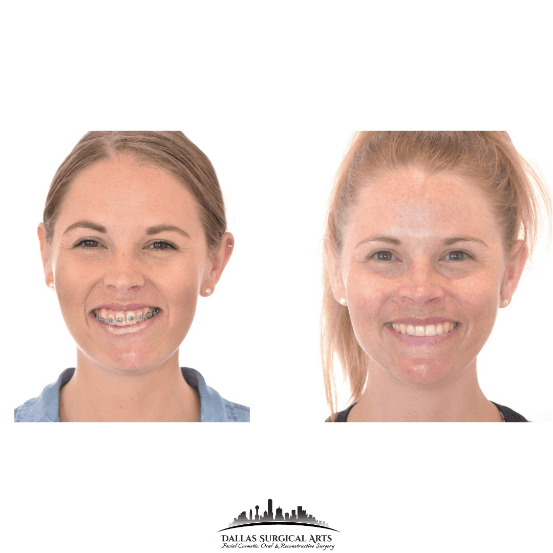 TMJ Surgery | Dallas Oral Surgery
