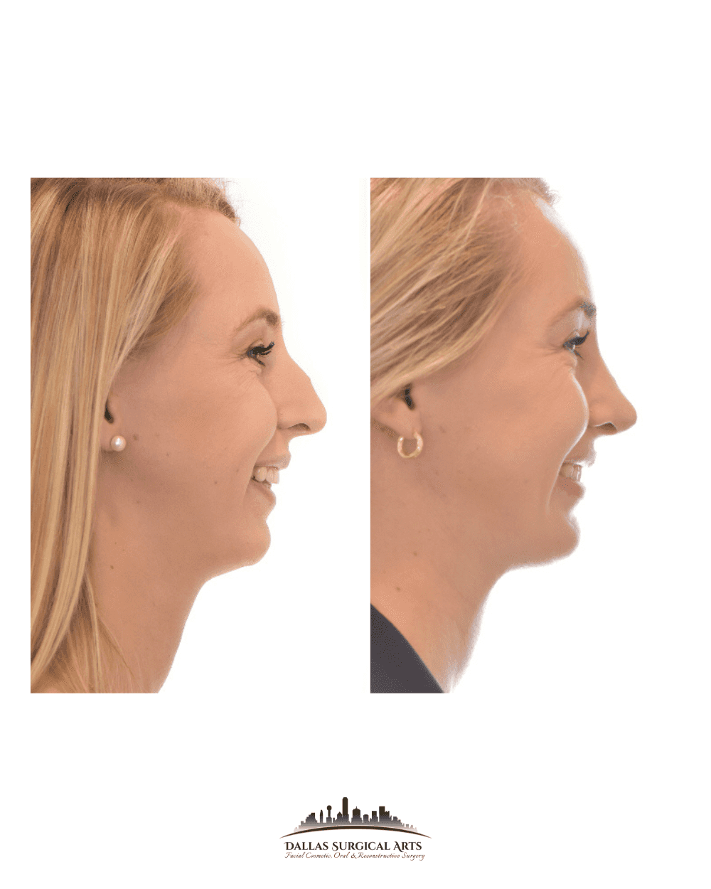 TMJ Surgery | Oral Surgery in Dallas