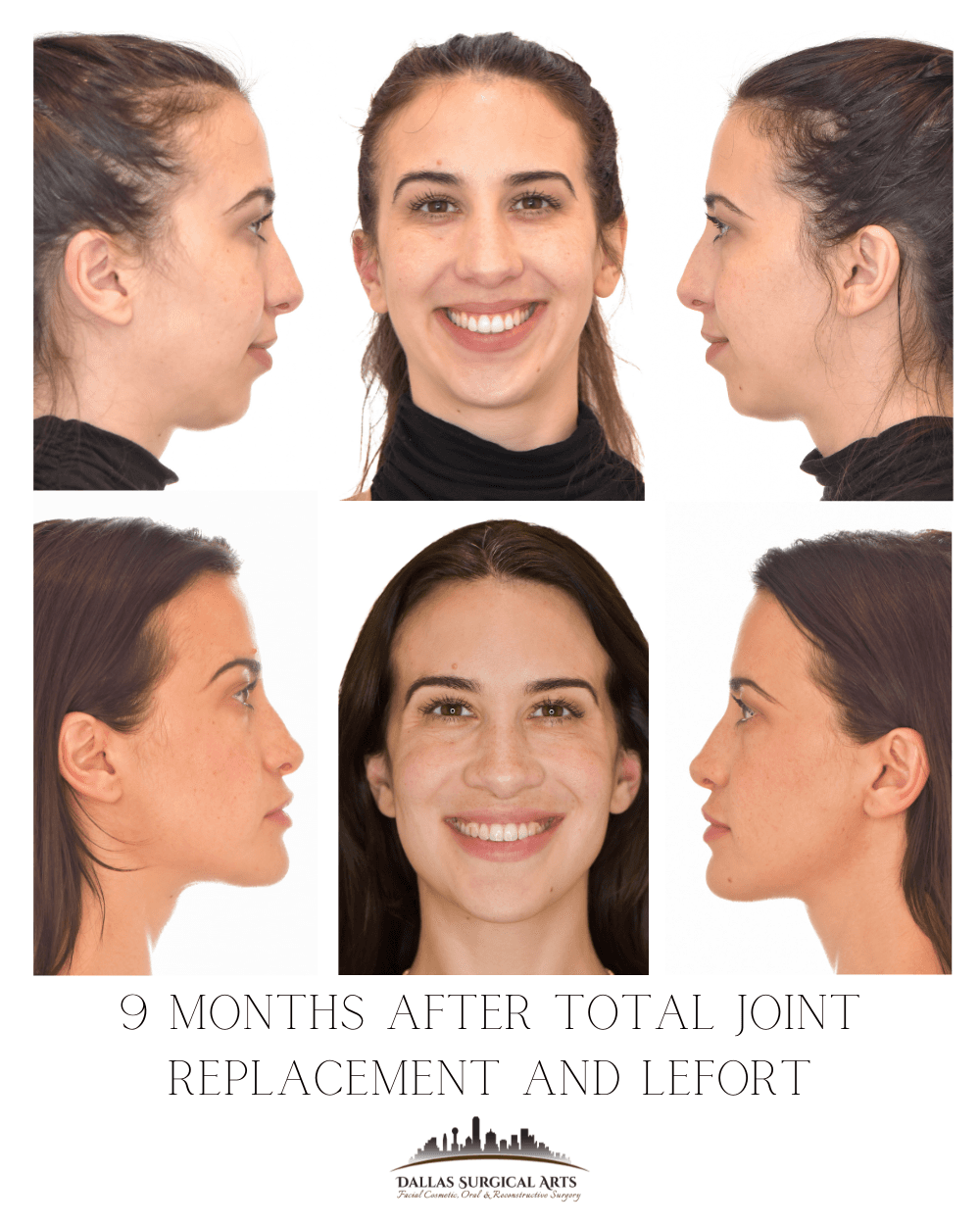 TMJ Surgery | Dallas Oral Surgery